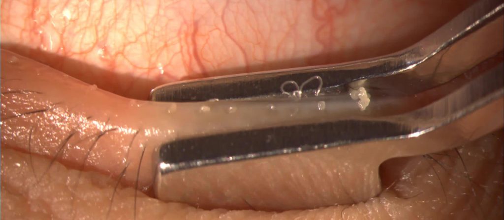 Firefly M Digital Slit Lamp with Meibography – ROI2020